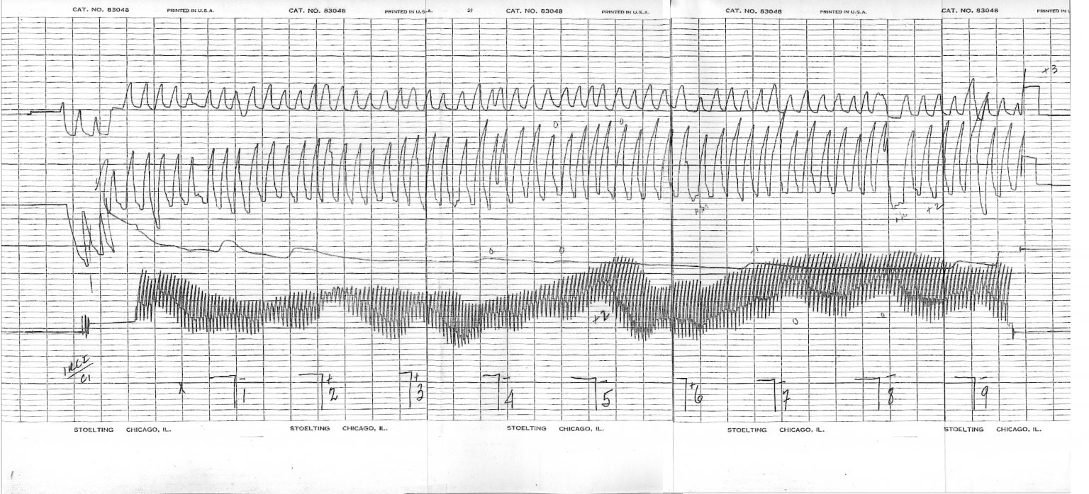 “Green River Killer” Gary Leon Ridgway’s Polygraph Charts ...