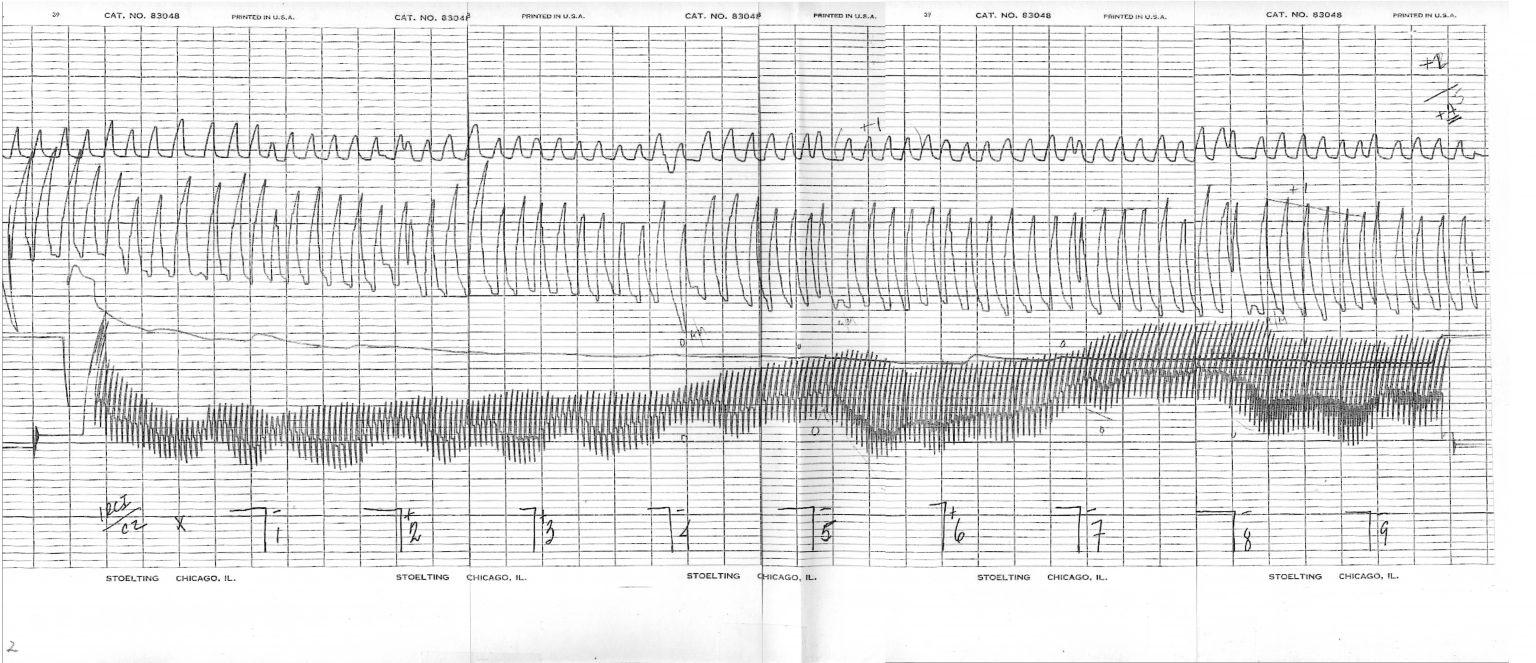 “Green River Killer” Gary Leon Ridgway’s Polygraph Charts ...